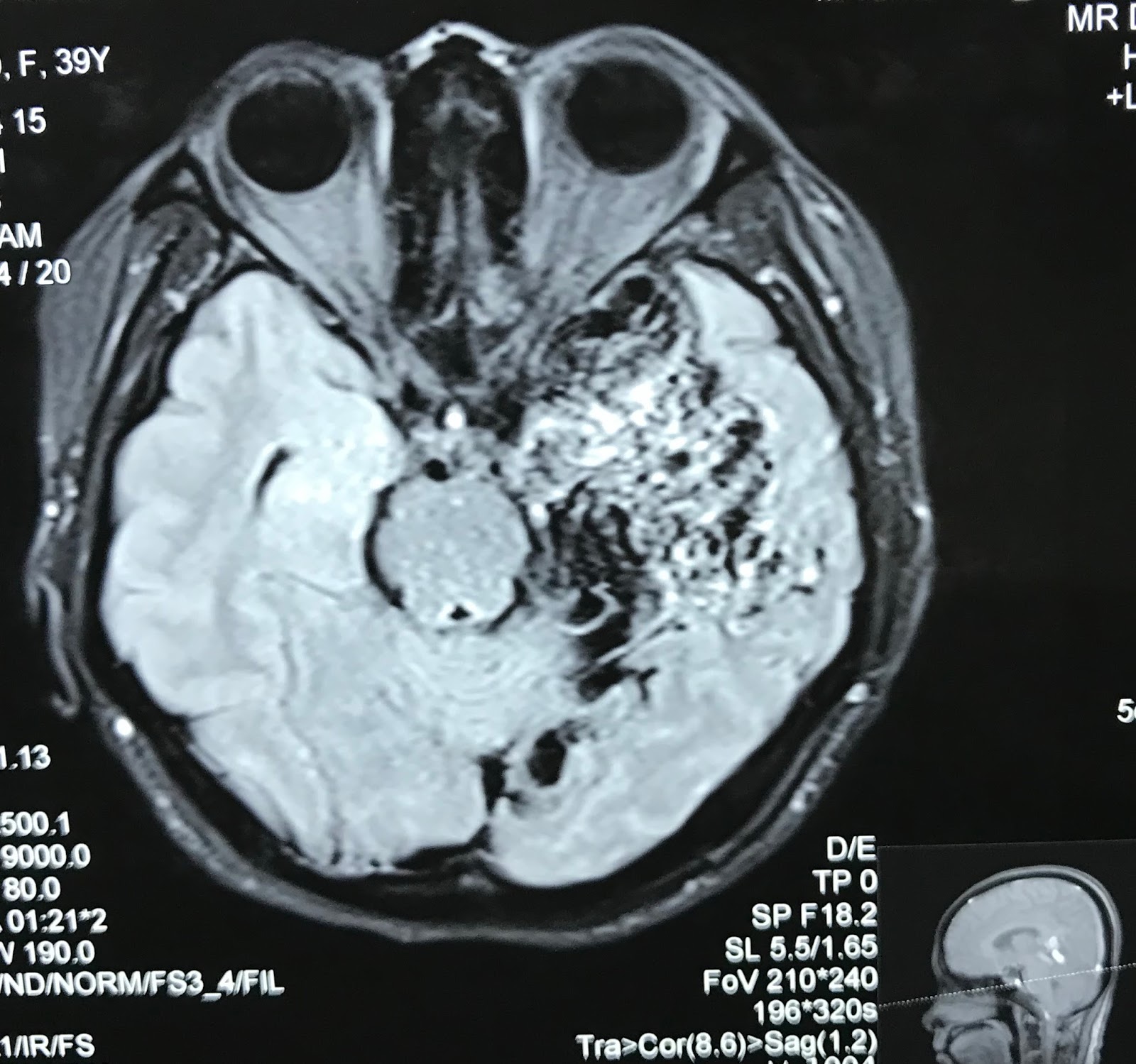 VIETNAMESE MEDIC ULTRASOUND: CASE 487: BRAIN AVM, Dr PHAN THANH HẢI ...