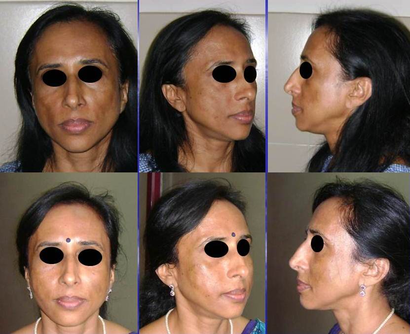 Plastic and Cosmetic Surgery: Fat Injection – A boon for the Plastic ...