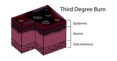 Askep Luka Bakar - askep