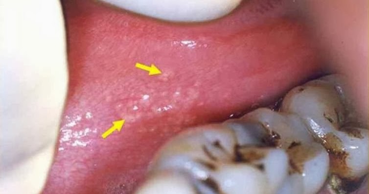 :: World Of Dentistry ::: Fordyce Granules