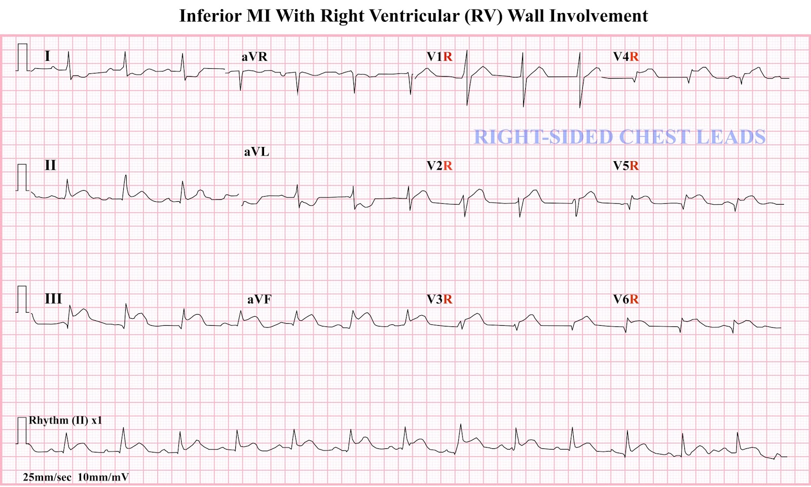 ECG Educator Blog : Acute coronary syndrome and infarctions