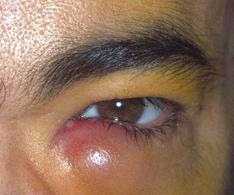 VETAMINMIN: Ini Tentang SAKIT MATA