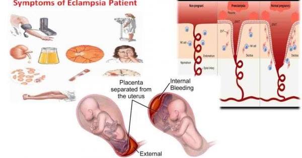 What Is Eclampsia? - Teroes