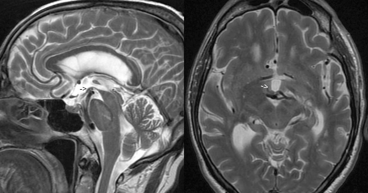 Dr Balaji Anvekar FRCR: Mamillary body compression by Basilar ...