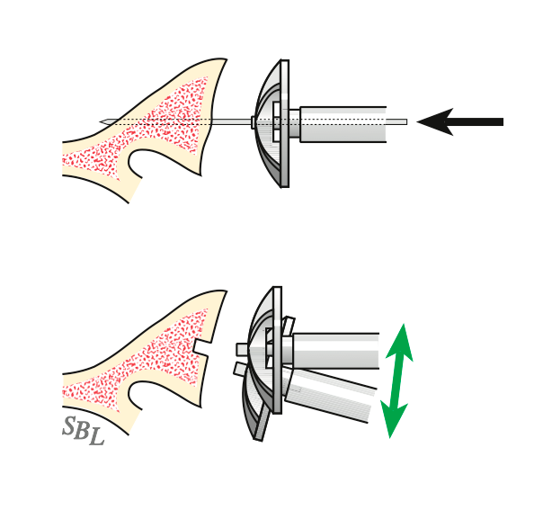 Shoulder Arthritis / Joint Replacement : Posterior augmented glenoid ...