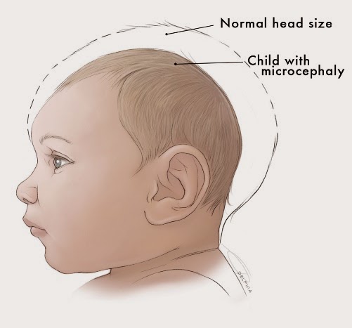 Microcephaly | Everything