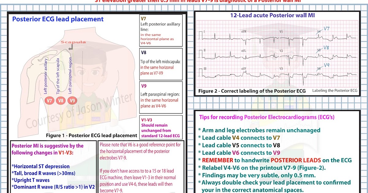 ECG Educator Blog : Posterior ECG Lead Placement