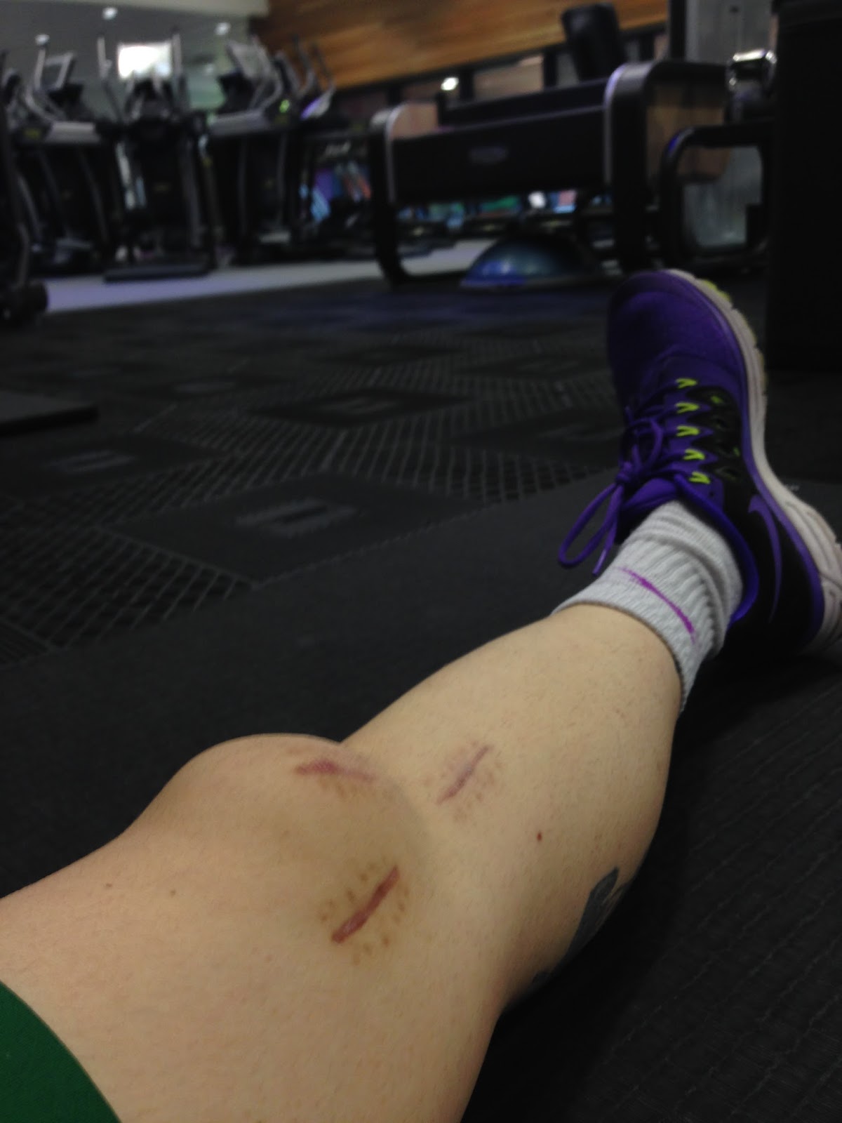 My Experience Having MPFL Reconstruction Surgery