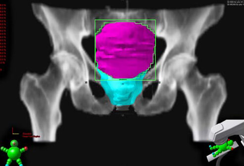 Healthy Life: Bladder Cancer