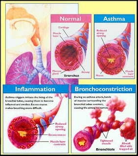 ChyntiaBlog: Asma Bronchial