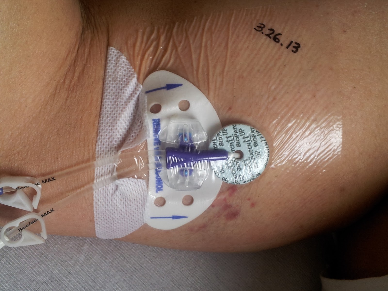 Journey of a Sarcoma Patient: March 25, 2013 - Begin Round 3 of Chemo