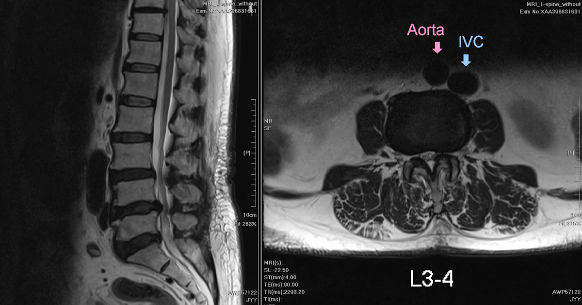放射醫傑克: Situs inversus on L-spine MRI