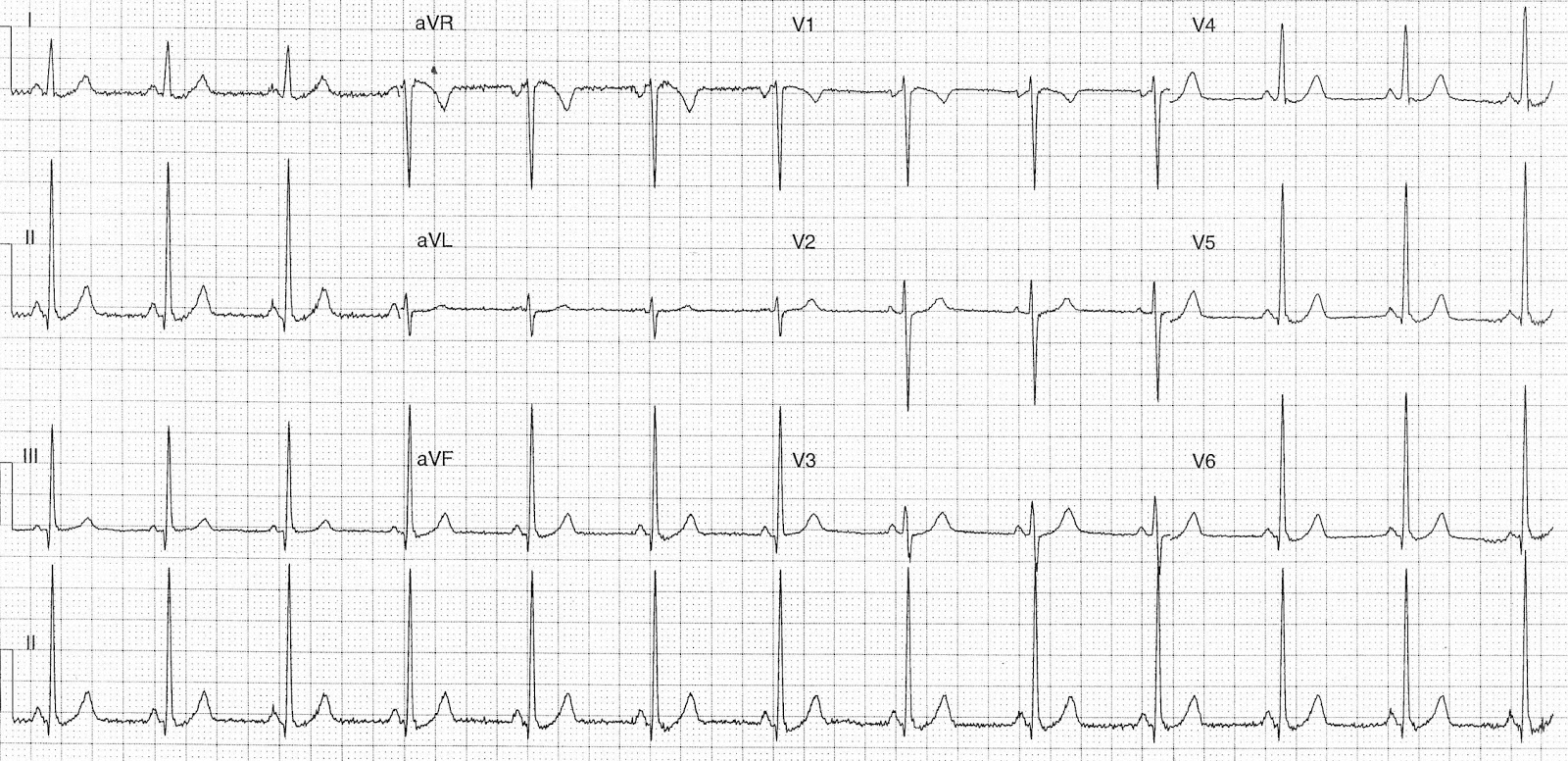 ECG of the Week: ECG of the Week - 27th July 2015 - Interpretation
