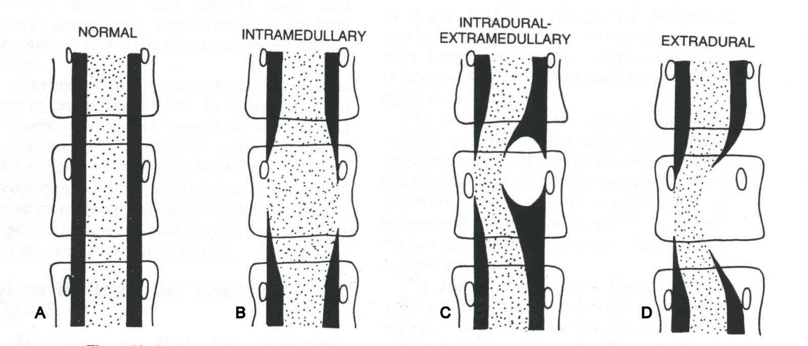 Dr Balaji Anvekar FRCR: Intraspinal mass, a nerve sheath tumor on MRI ...