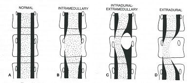 Dr Balaji Anvekar FRCR: Intraspinal mass, a nerve sheath tumor on MRI ...