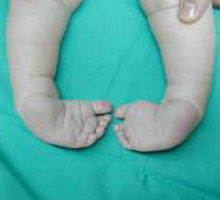 claraley: PIE EQUINOVARUS O PIE ZAMBO