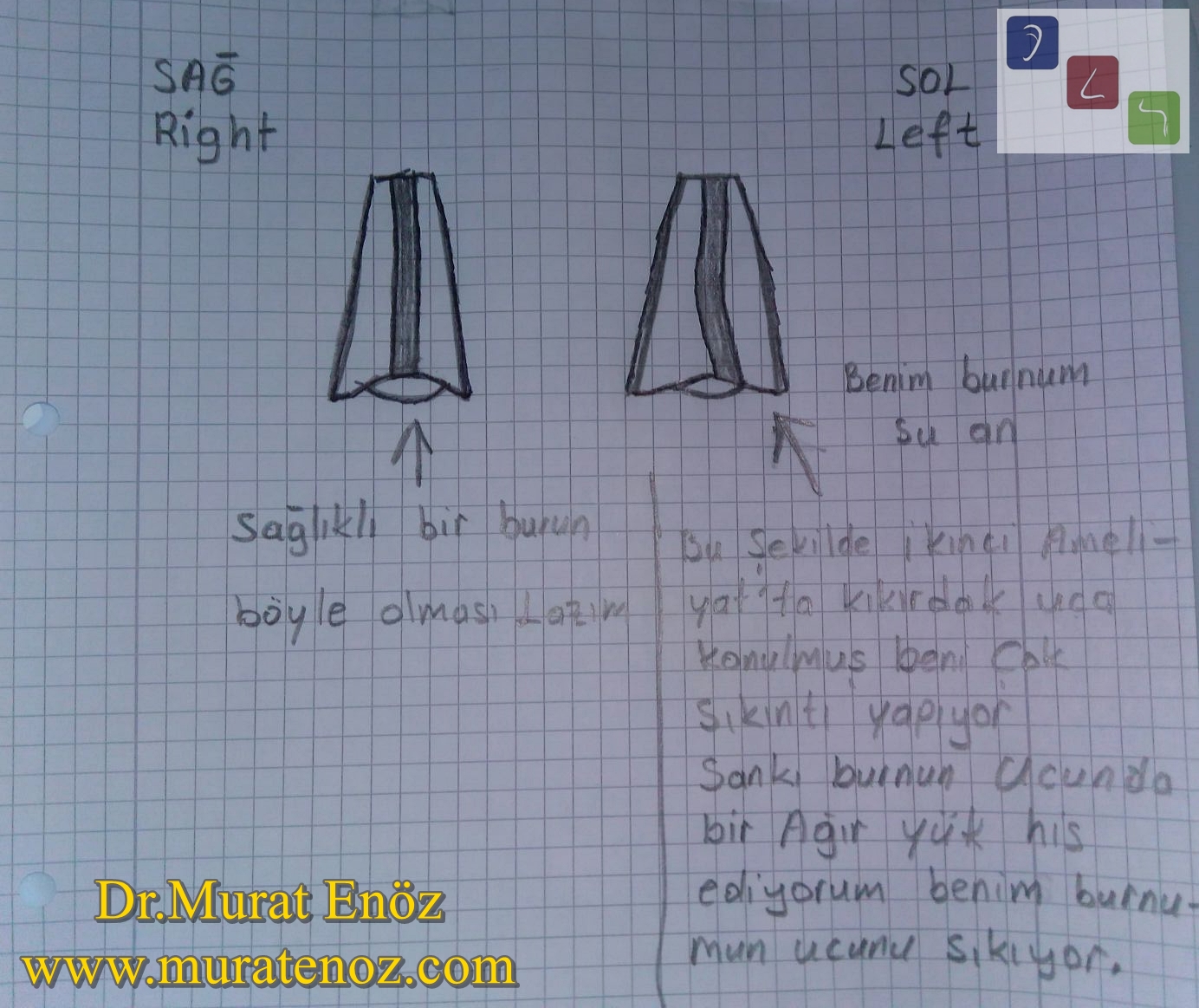 Hastam "Kaudal Septum Deviasyonu" nu Kağıda Çizerek Anlatmış!