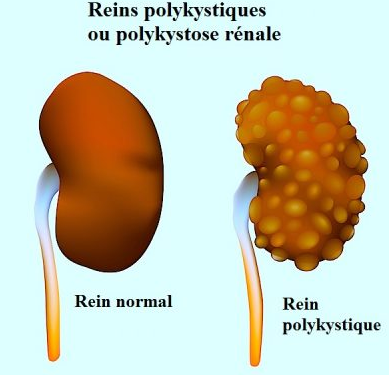 traitement de l'insuffisance rénale: Comment traiter l'urémie en raison ...
