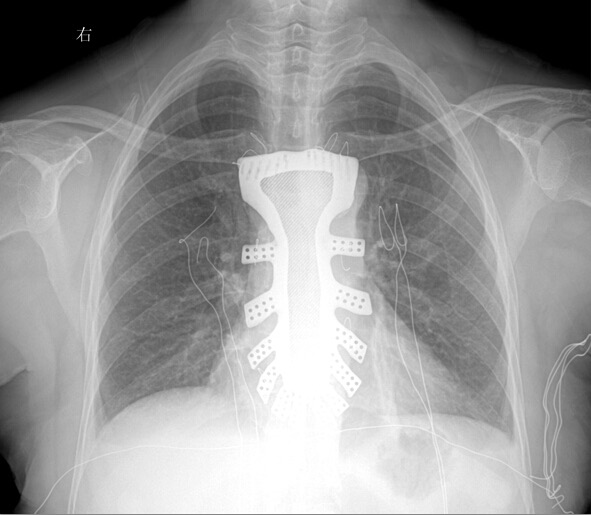 Sterno artificiale - 人造胸骨 - Artificial sternum: Sintesi finale