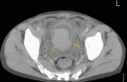 Bladder Rupture-CT - Sumer's Radiology Blog