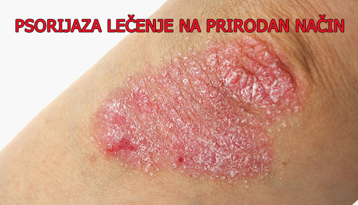 Psorijaza lečenje na prirodan način ~ Recepti i Ideje