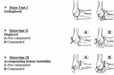 i love physical therapy: Mayo classification for olecranon fractures