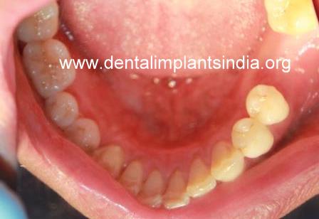Chinthamani Laser Dental Clinic: REPLACEMENT OF SINGLE MISSING BACK ...