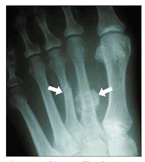 Julie Dunkle Ironman Coach: Hard Callus Formation and A Business Deal ...