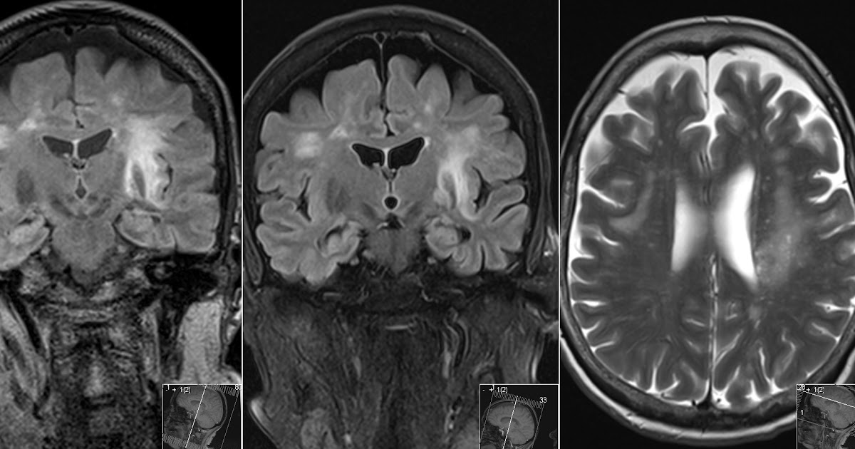 PML - Progressive Multifocal Leukoencephalopathy