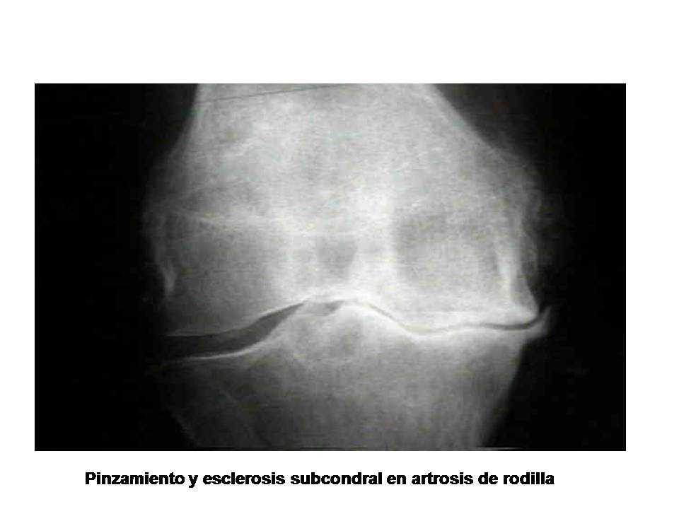 Diagnóstico de la artrosis