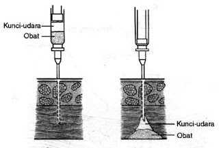 SOP Injeksi Intramuscular (IM) ~ Ns. RIO CRISTIANTO