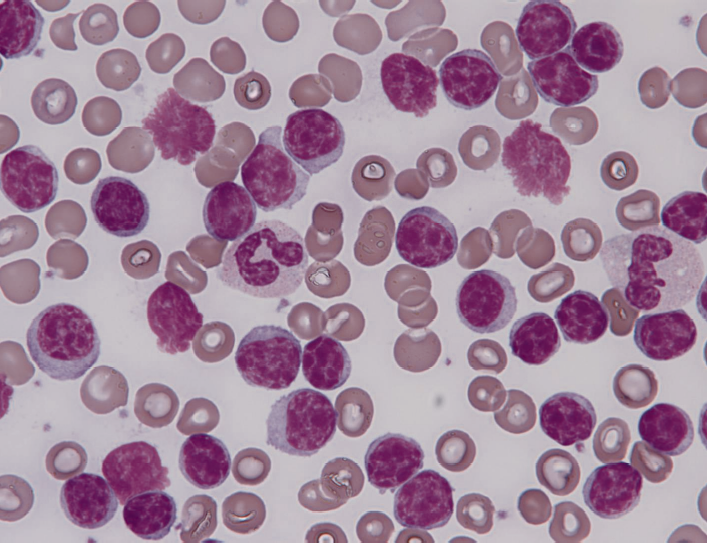 Células Sanguíneas: Leucemia Linfoide y Mieloide Crónica