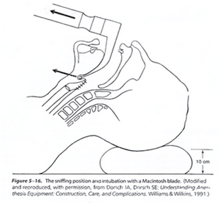 Perawat Samarinda: Prosedur Pemasangan ETT ( Intubasi )