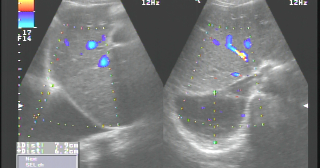 VIETNAMESE MEDIC ULTRASOUND: CASE 532: URINOMA and A 2-Year Tap Wound ...