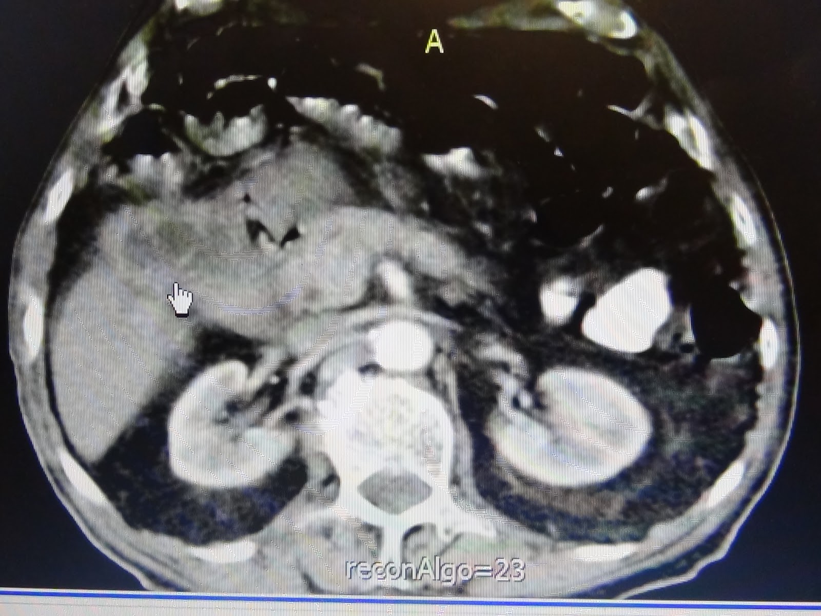 Endoscopia y Cirugía Digestiva: CARCINOMA DE LA VESÍCULA BILIAR