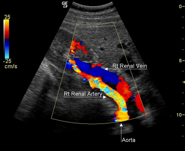 Renal artery doppler ultrasound - batmanjava