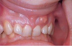 Dentistry lectures for MFDS/MJDF/NBDE/ORE: Lesions of the oral ...