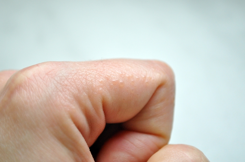 Keep calm and be beautiful: Egzema - kolejna przypadłość do kolekcji?