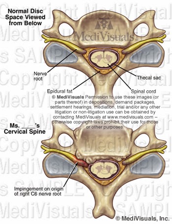 The Medical Legal Exhibit Expert Blog: Understanding the Osteophyte ...