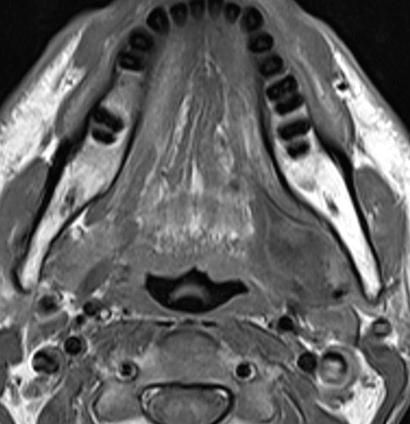 Ránula | Radiologia de cabeza y cuello