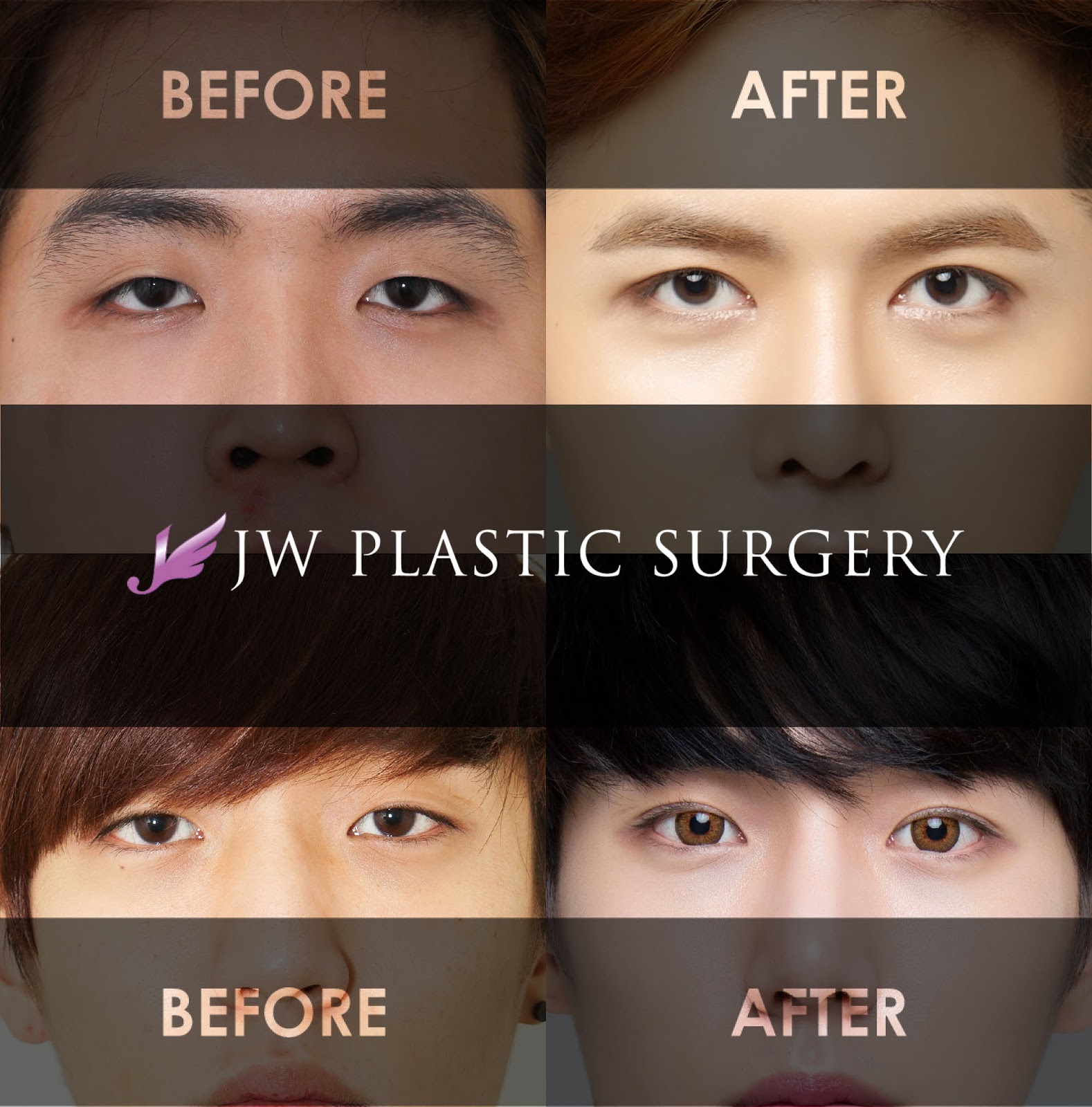 Korean Plastic Surgery Before And After Male