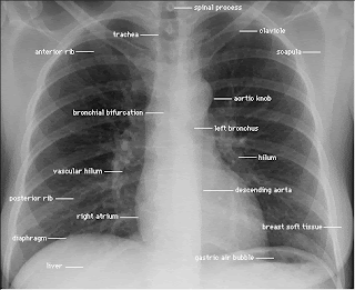 Adventures in Radiation: Here's a chest xray with anatomy labeled.