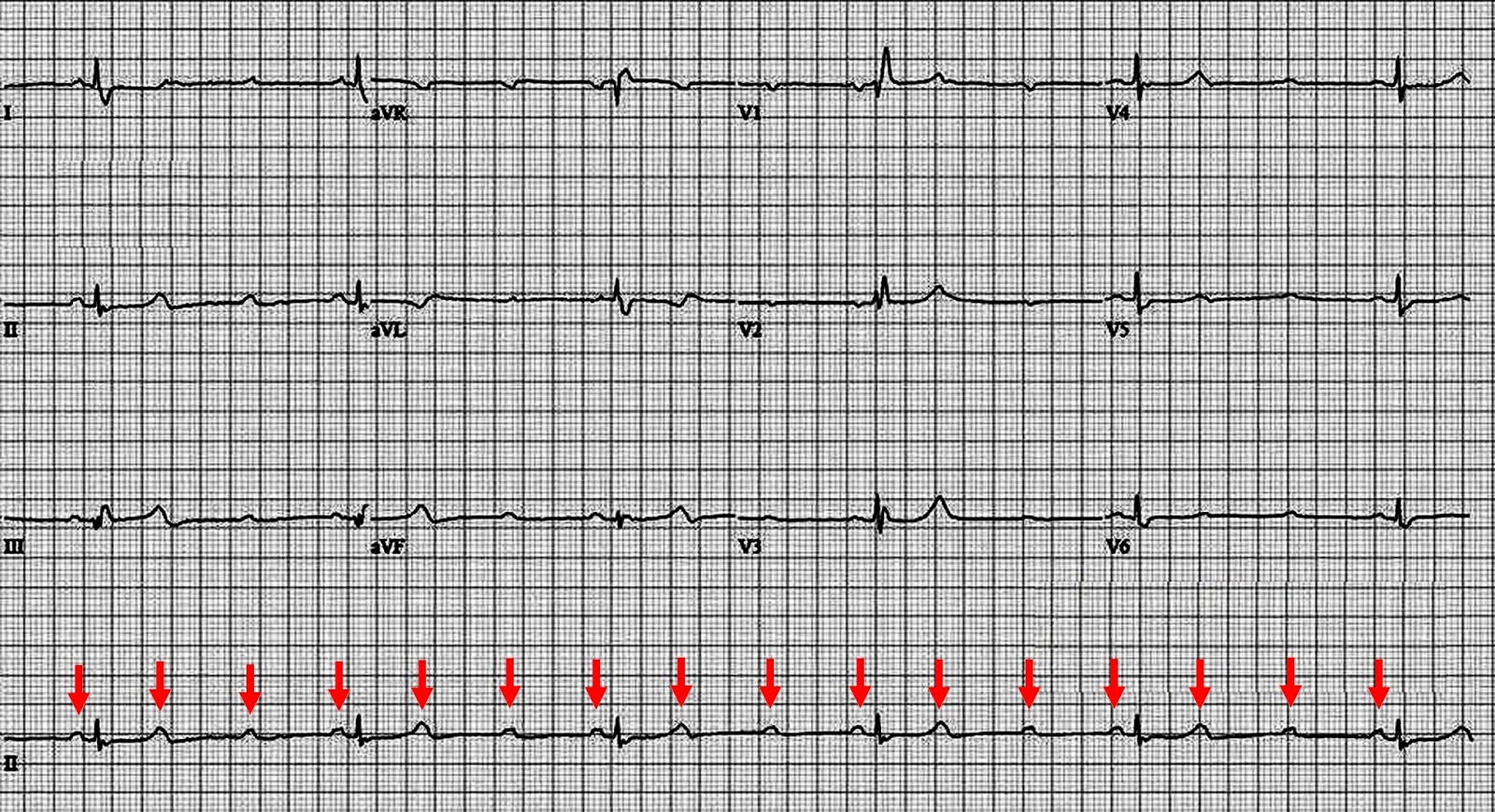 ECG Channel: Atrioventricular Block
