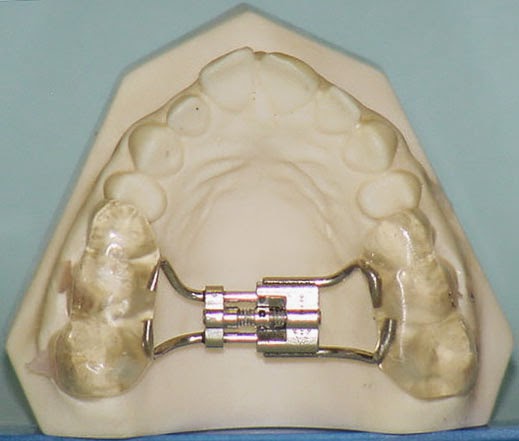 James R. Waters, DDS, MSD, PA: Expansion Therapy for the Developing ...