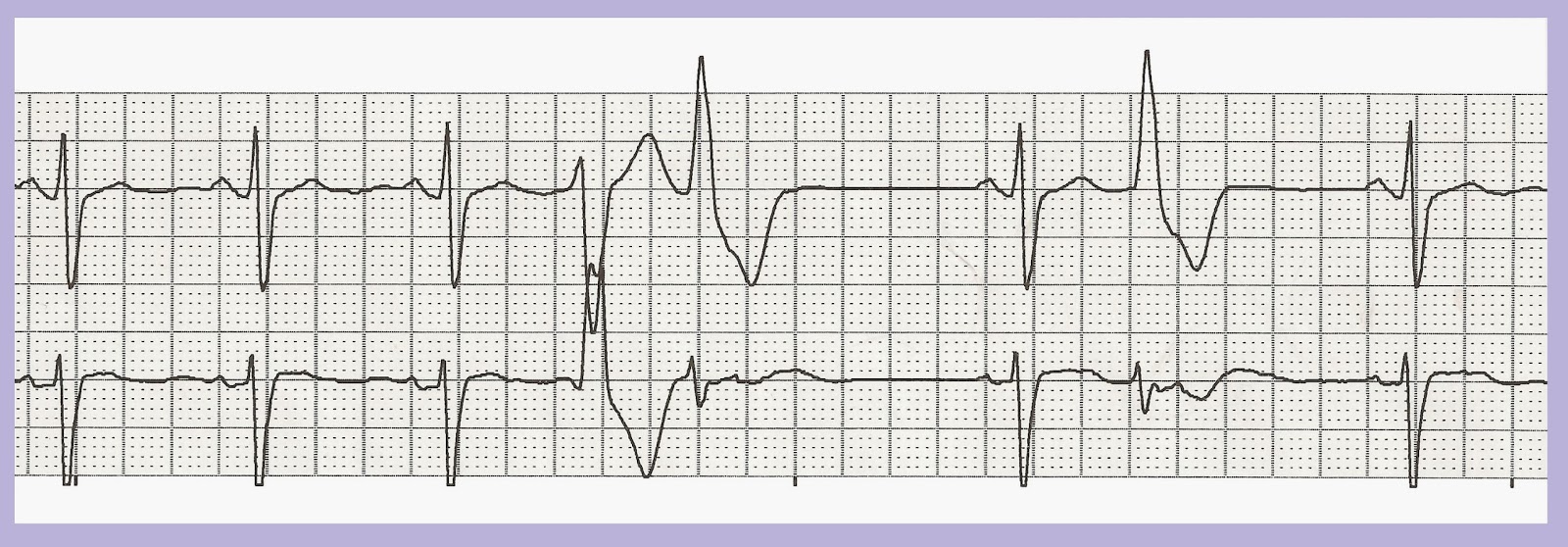 Practice Rhythm Strips 243