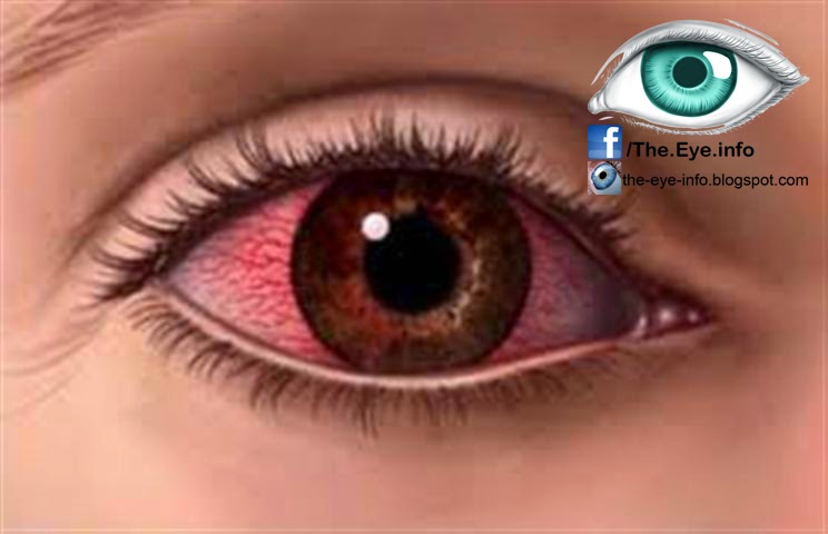 أحمرار العيون اسبابها وطرق العلاج - The eye