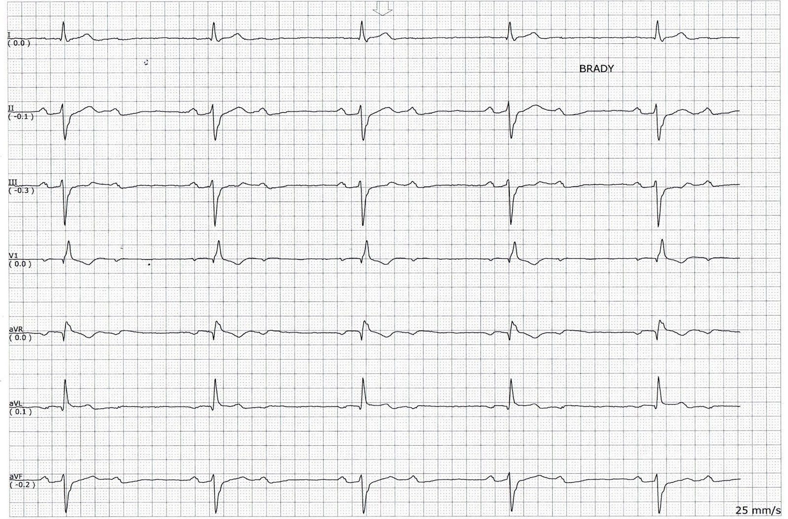 ECG Rhythms: A 2:1 is not Mobitz II
