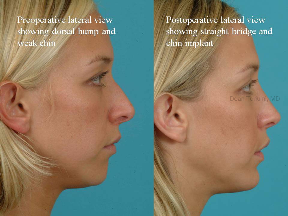 Dr. Dean Toriumi Reviews: Dean Toriumi Reviews: Crooked nose and Nasal ...