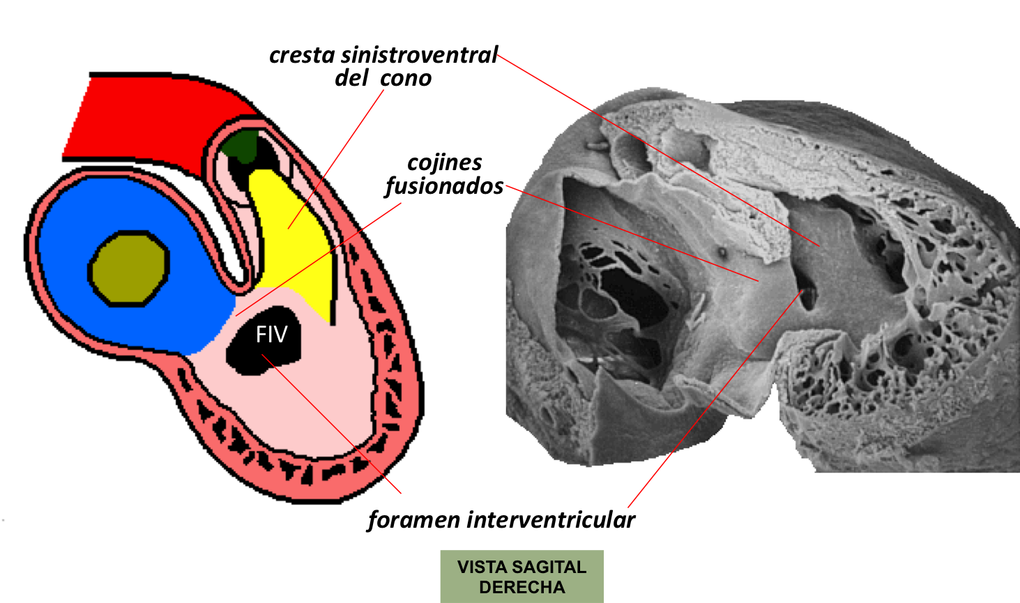 SOS EMBRIOLOGIA HUMANA: DESARROLLO DE CORAZON. FORAMEN INTERVENTRICULAR