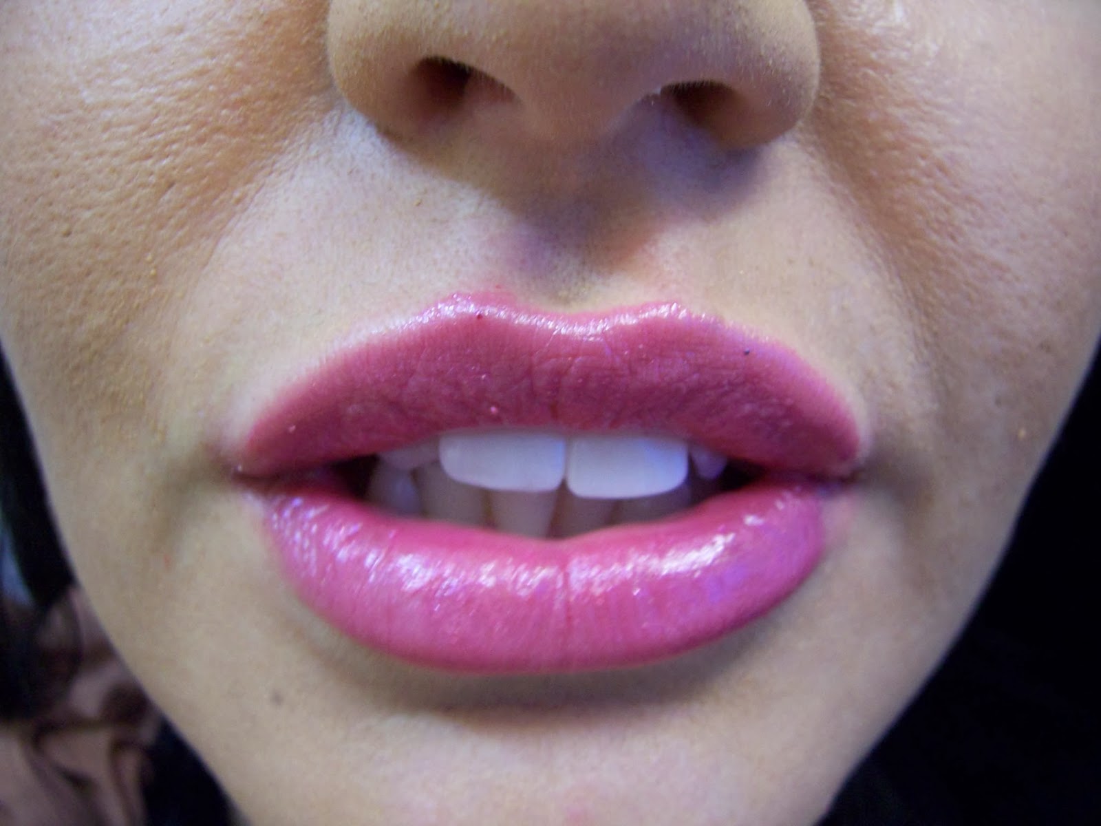 Appledore Dental Bracknell: Bracknell cheek lift or pouty lips?